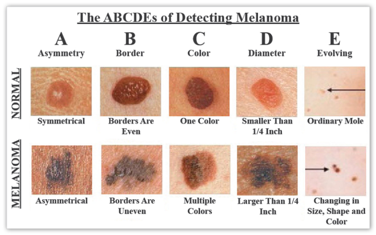 Visual : ABCs of Melanoma: Guide to differentiating melanoma from a ...