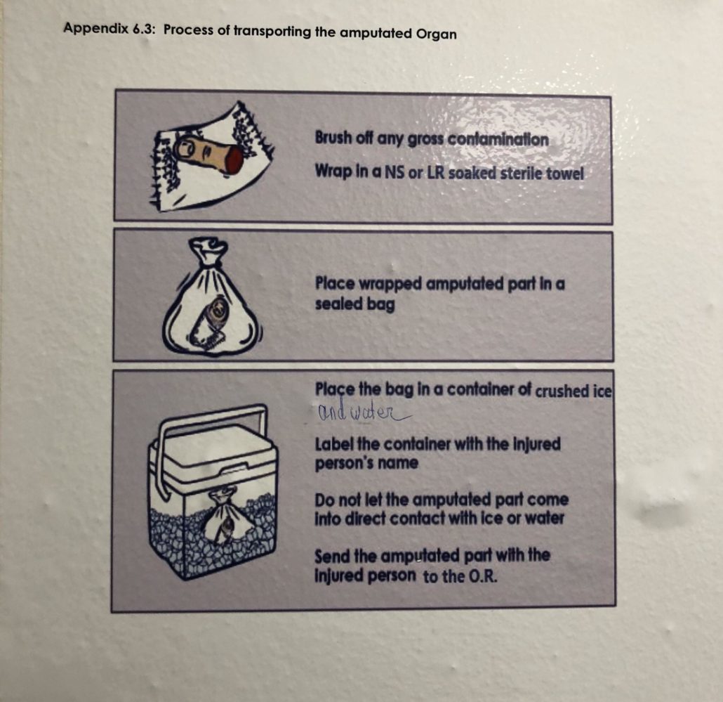 Visual : Incase of Amputation – Infographic.tv – Number one ...