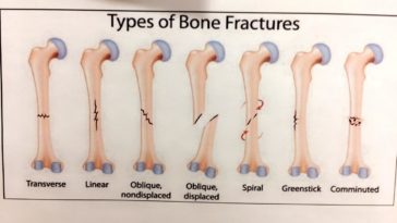 Visual : Types of Bone Fractures guide – Infographic.tv – Number one ...