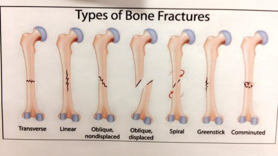 Visual : Types of Bone Fractures guide – Infographic.tv – Number one ...